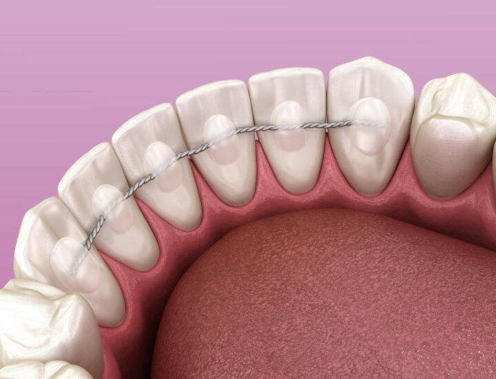 Retainers Pearland Texas | Pediatric Dentistry